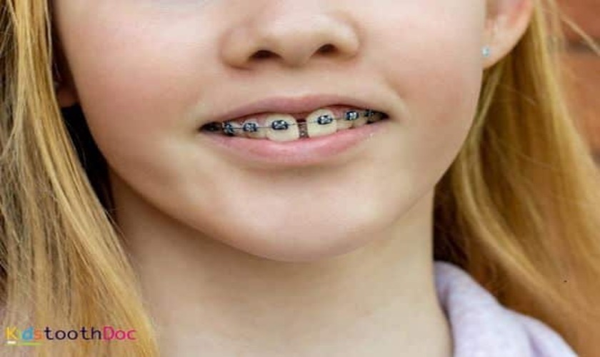 Real Stories from People Who Have Benefited from Invisalign Treatment ...